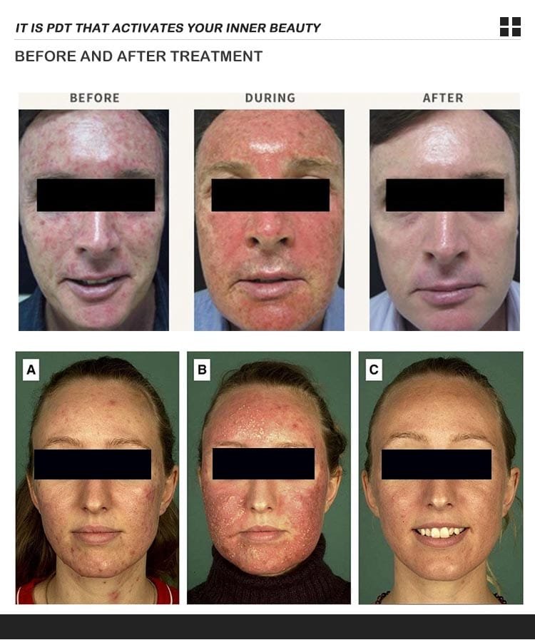 History And Advantages Of PDT Machine Companies – MAIKONG PDT Machine ...