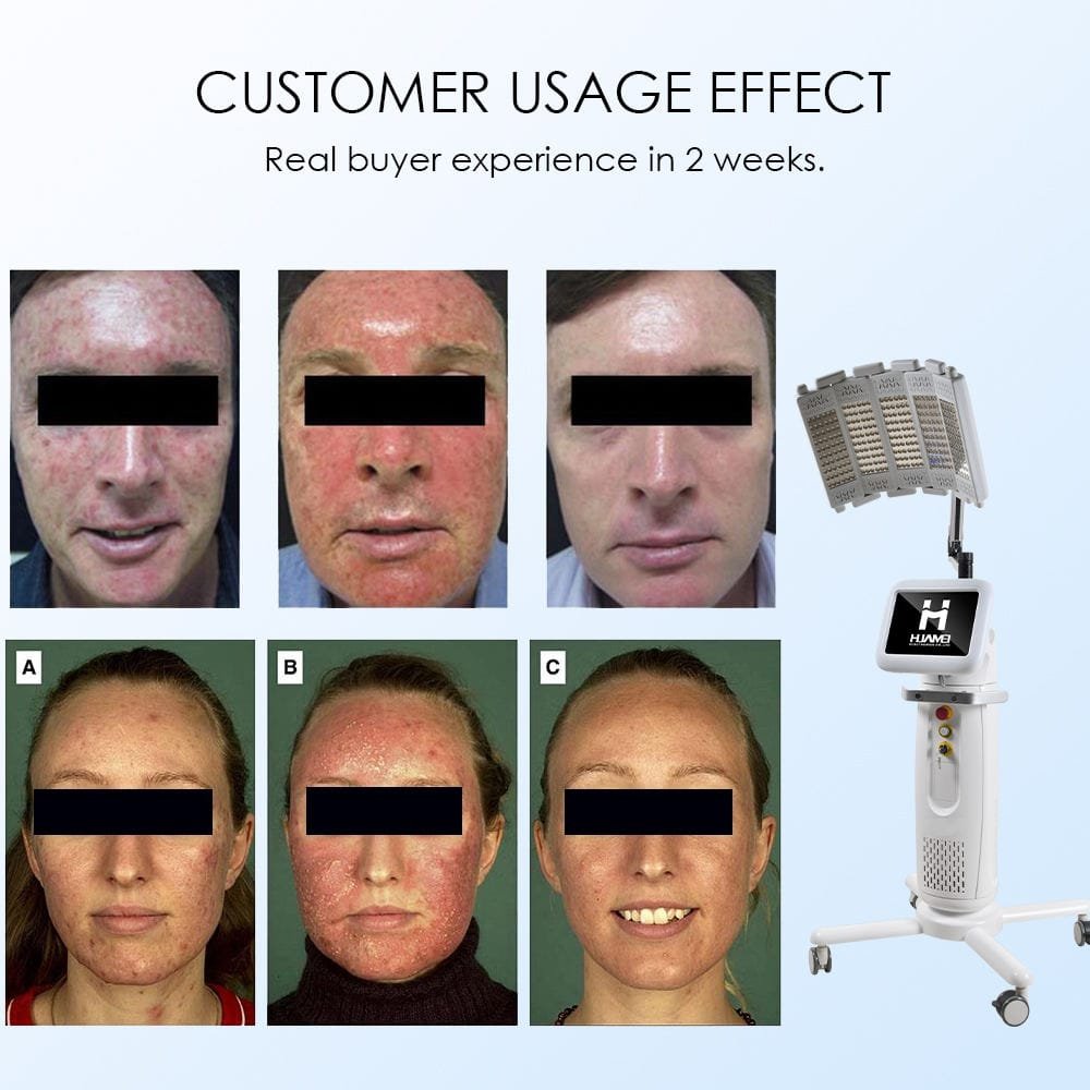 Photodynamic Therapy (PDT): Illuminating The Future Of Skin ...